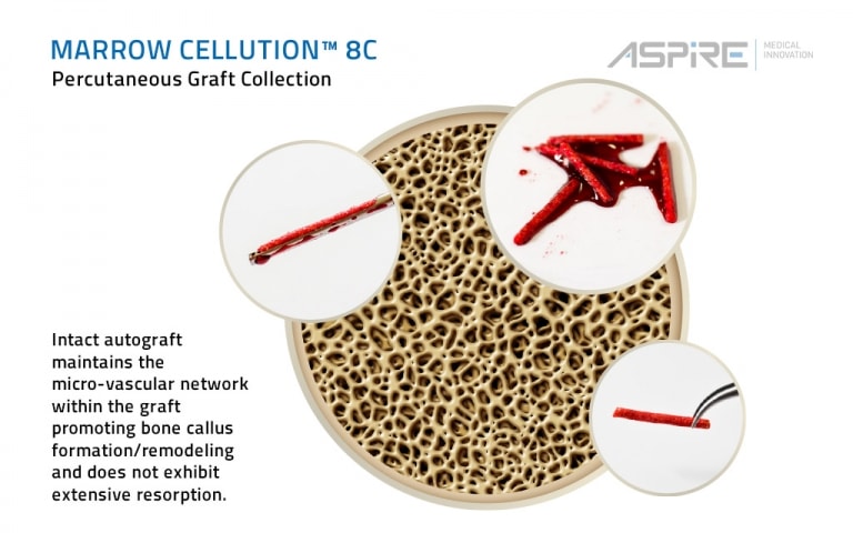 MARROW CELLUTION™ 8C | Aspire Medical Innovation
